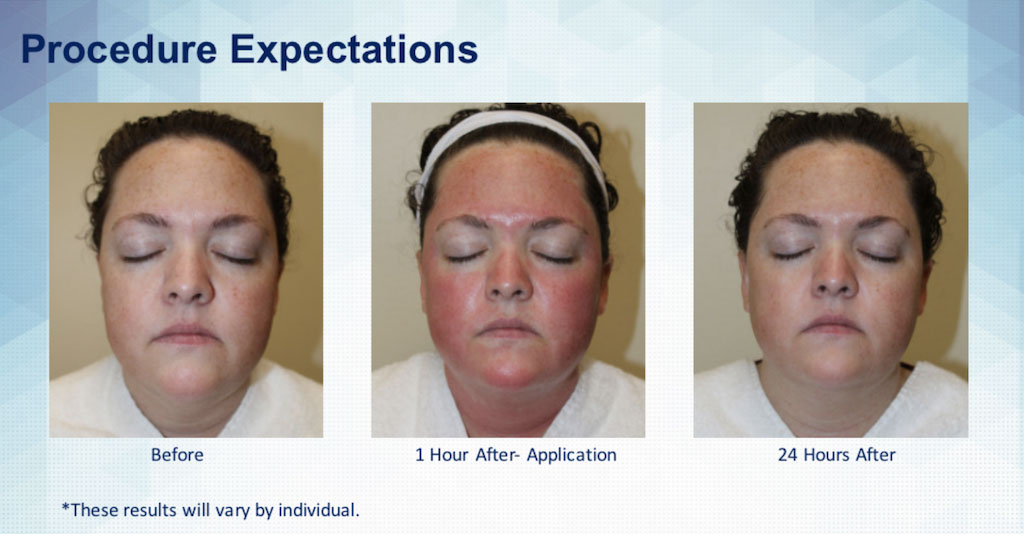 SkinPen - Llandeilo Dental Practice